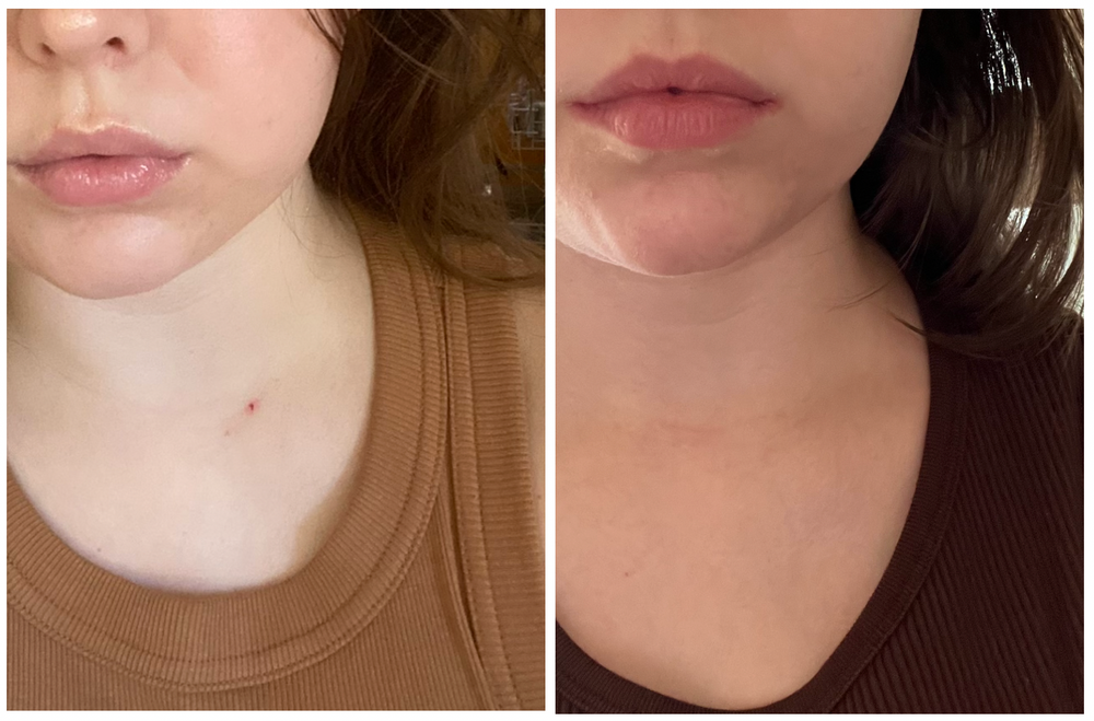 How to fix broken capillaries (with before and afters)