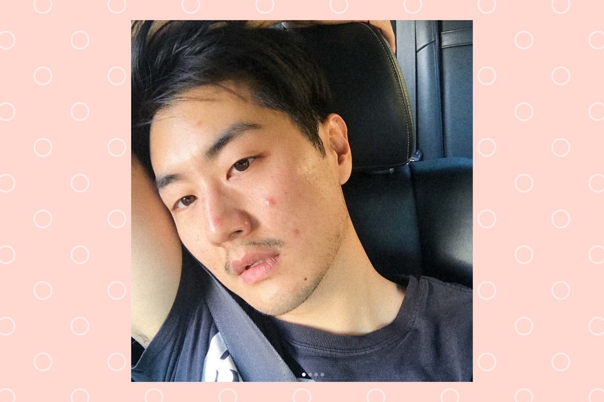 Everything you can do to shrink your cystic acne in half